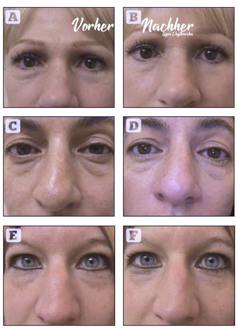 Atlantis Beauty - Carboxytherapie